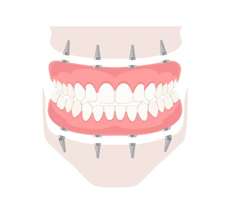 Full Arch Implants - Sleep Dentistry | Permanent Full-Mouth Tooth ...
